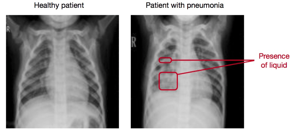 Improve AI Model for Pneumonia Detection in X-Rays with Saimple