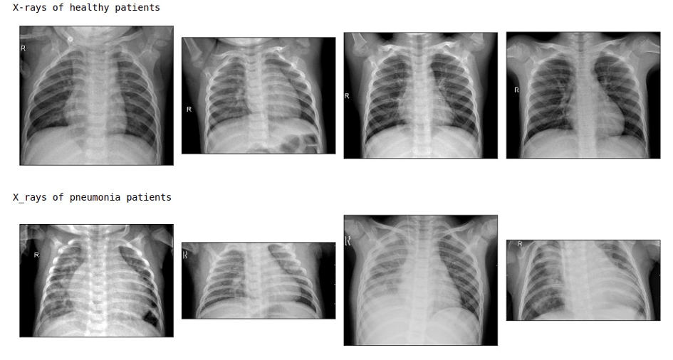 Improve AI Model for Pneumonia Detection in X-Rays with Saimple