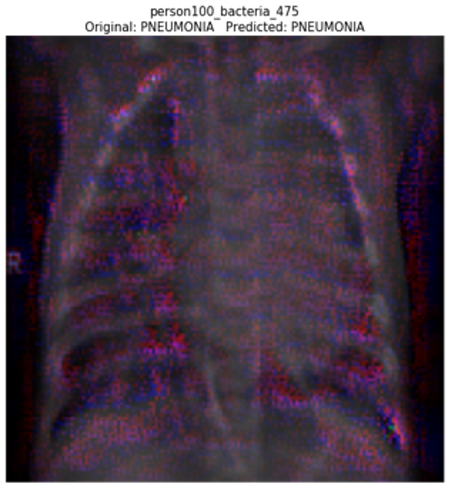 Improve AI Model for Pneumonia Detection in X-Rays with Saimple