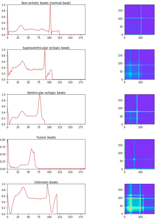 Validating The Reliability Of Ai Algorithms For Detecting Cardiac Arrhythmias In Ecgs