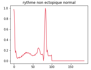 Validating the reliability of AI algorithms for detecting cardiac arrhythmias in ECGs