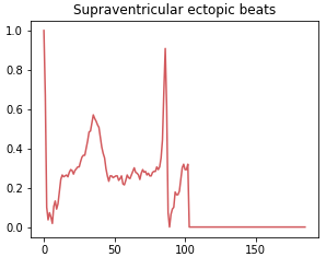 Validating the reliability of AI algorithms for detecting cardiac arrhythmias in ECGs