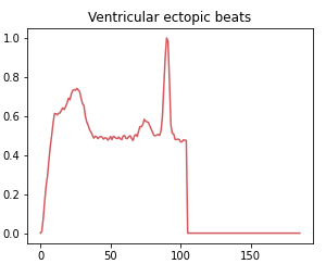 Validating the reliability of AI algorithms for detecting cardiac arrhythmias in ECGs